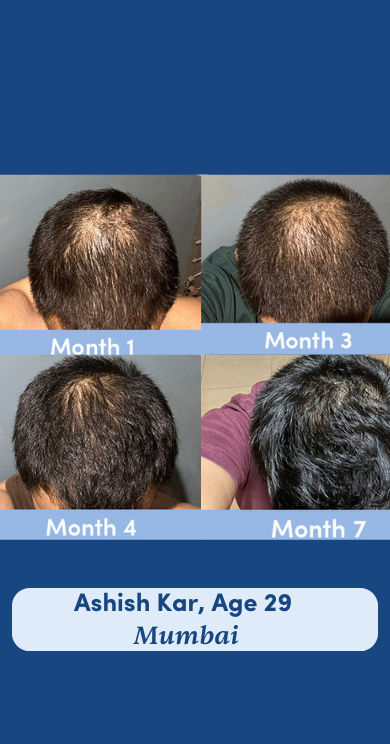 Stop Hair Loss with Science Backed Products | No Side Effects