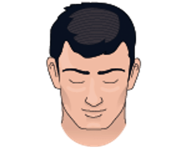 Stage 1 (Little or no hairline recession)