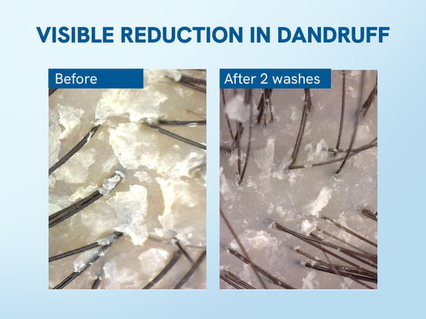 Anti Dandruff Starter Pack | Bodywise