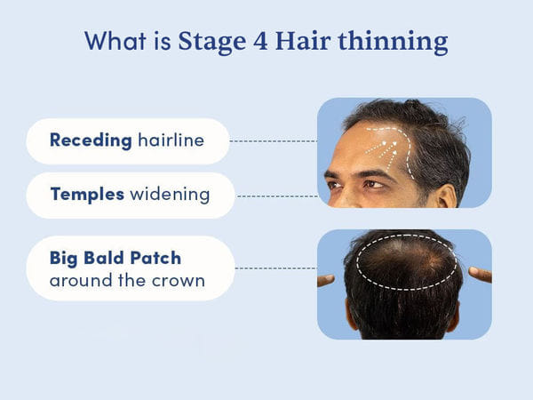 Buy the Hair Starter Pack for Hair Strengthening - Man Matters